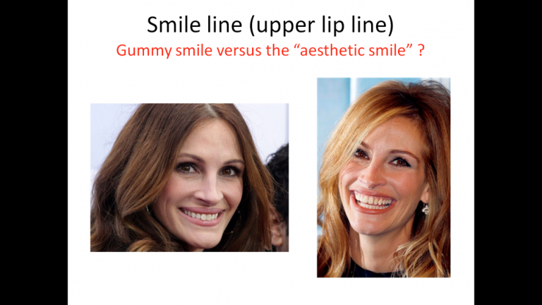 Gummy Smiles - Medical Orofacial Surgery